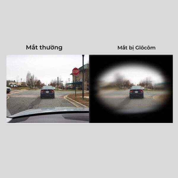 Bệnh Glôcôm là gì? Nguyên nhân, triệu chứng và cách điều trị