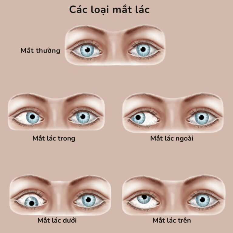 Bị lác mắt là gì? Nguyên nhân, triệu chứng và cách điều trị