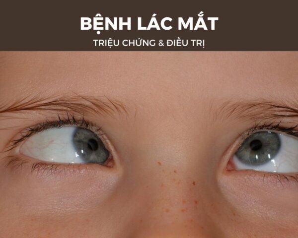 Bị lác mắt là gì? Nguyên nhân, triệu chứng và cách điều trị